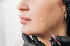 Thread Lifting - drkomaljerath